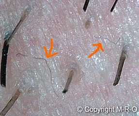 Morgellons Biologie pathogene mykotische Lebensformen, GMO Pilze ...